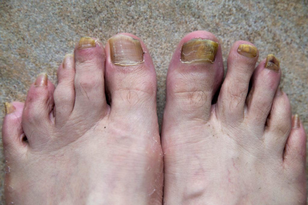 Skin and Toenail Conditions Archives - University Podiatry Associates