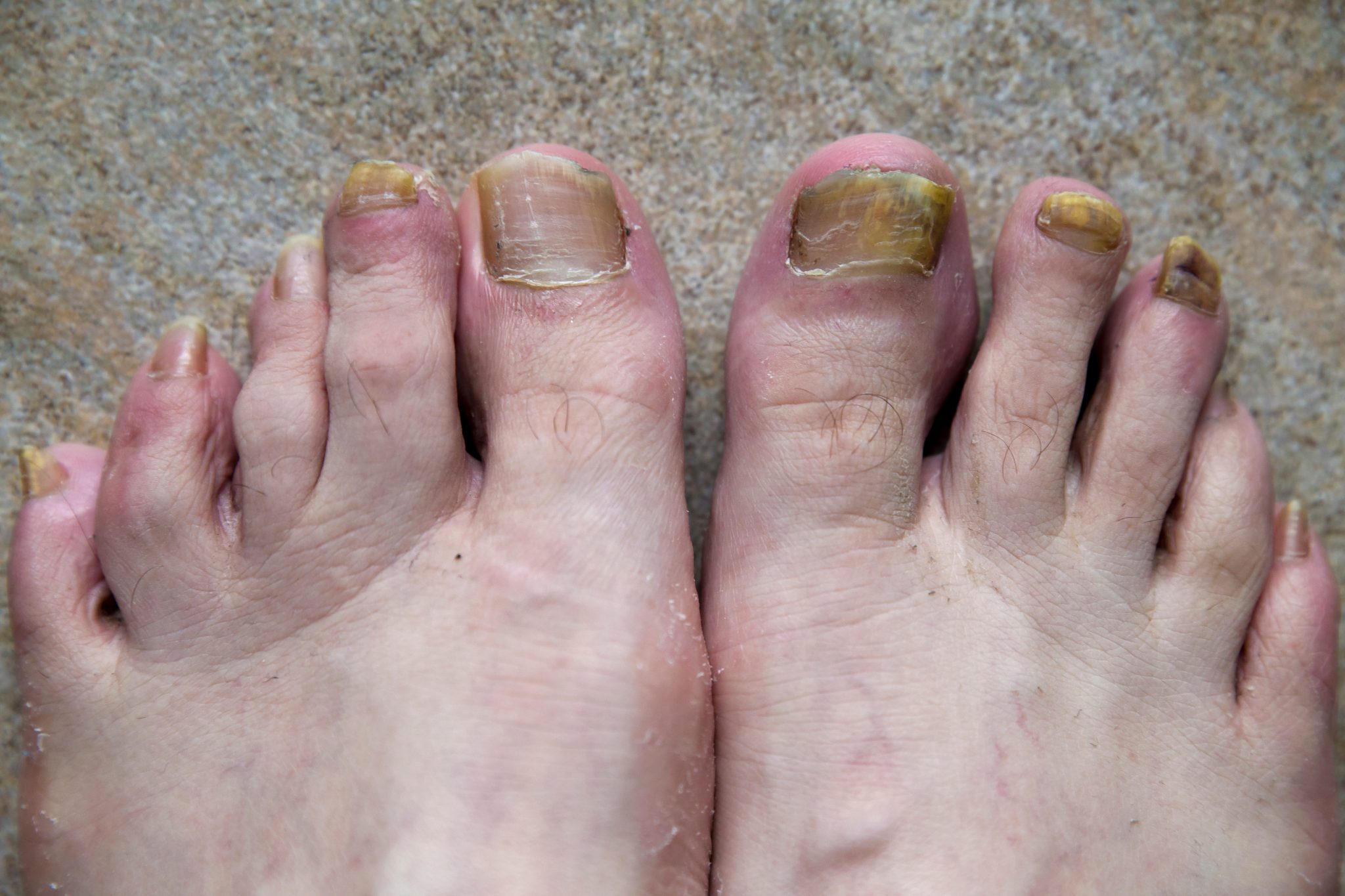 Skin and Toenail Conditions Archives - University Podiatry Associates