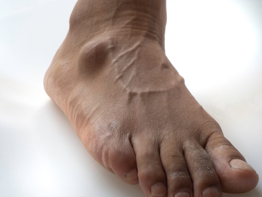 Cysts Archives - University Podiatry Associates